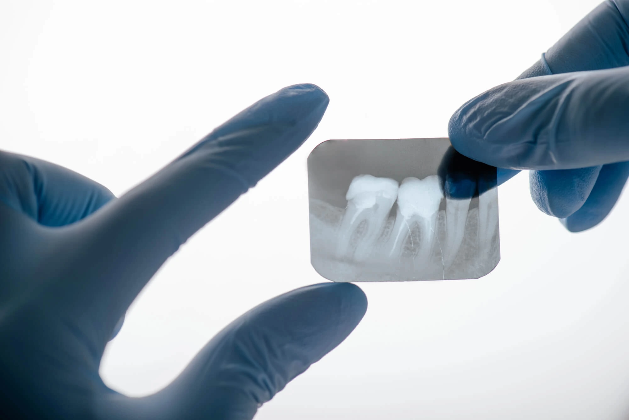 A Dental Filling Came Off? Here's What to Do - Bloink Dental